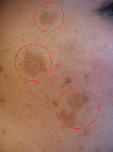 Tratamento para melasma no rosto