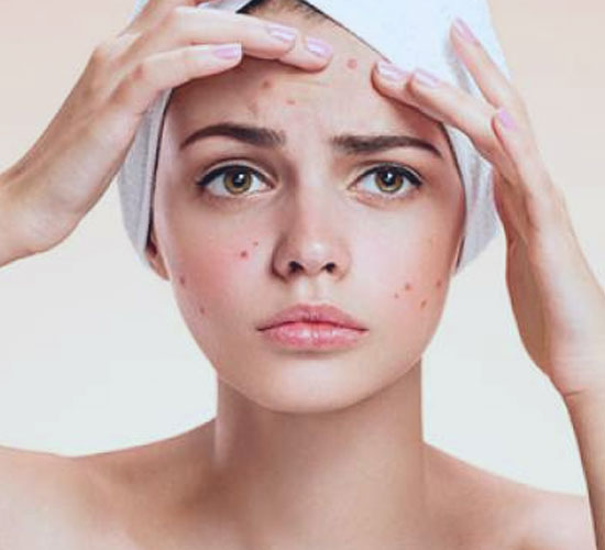 Como secar espinha inflamada? - Blog da Farmácia Eficácia